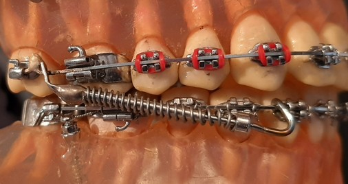 PROPULSOR MANDIBULAR FUNCIONAL (PMF B&V) Baptista & Valieri – Ortocompras