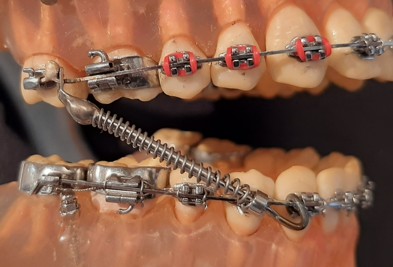 PROPULSOR MANDIBULAR FUNCIONAL (PMF B&V) Baptista & Valieri – Ortocompras