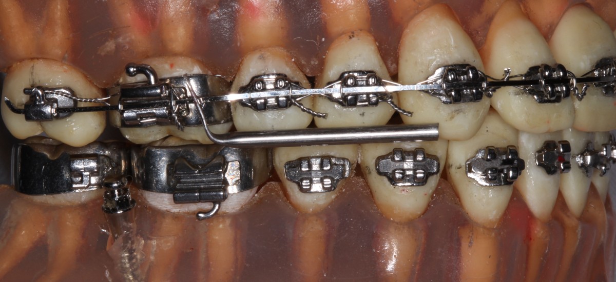 PROPULSOR MANDIBULAR FUNCIONAL (PMF B&V) Baptista & Valieri – Ortocompras