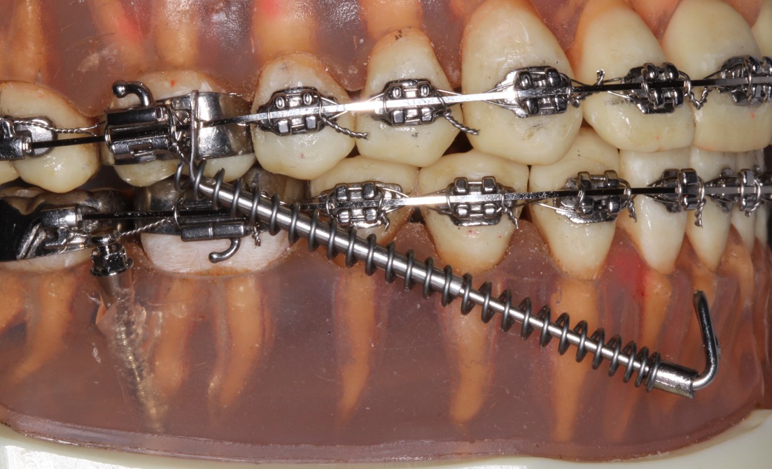 PROPULSOR MANDIBULAR FUNCIONAL (PMF B&V) Baptista & Valieri – Ortocompras