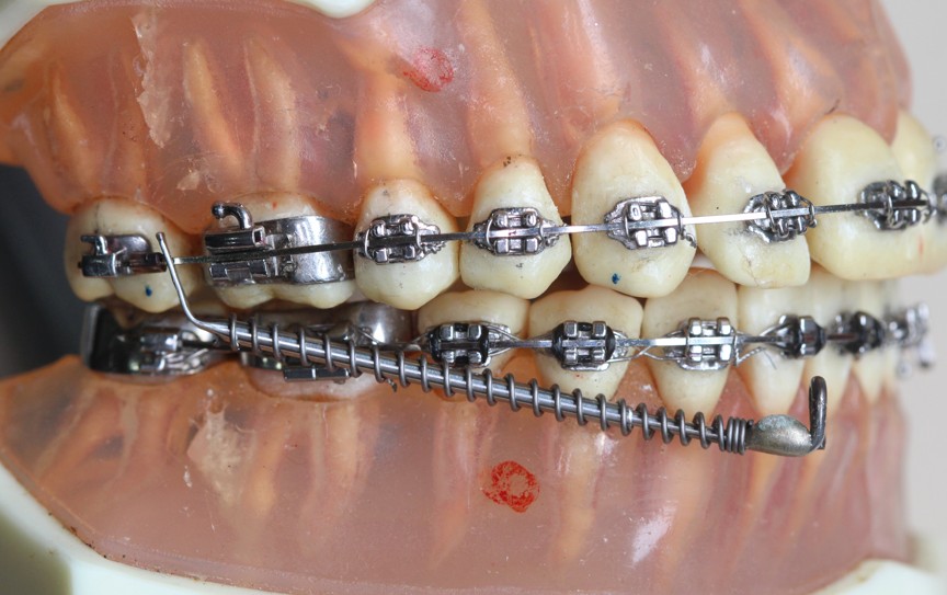 PROPULSOR MANDIBULAR FUNCIONAL (PMF B&V) Baptista & Valieri – Ortocompras