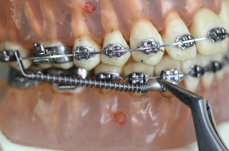 PROPULSOR MANDIBULAR FUNCIONAL (PMF B&V) Baptista & Valieri – Ortocompras