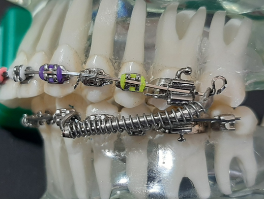 PROPULSOR MANDIBULAR FUNCIONAL (PMF B&V) Baptista & Valieri – Ortocompras