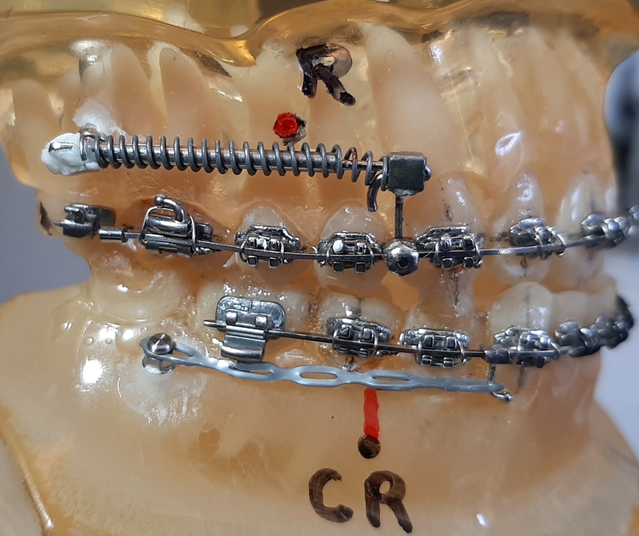 PROPULSOR INTRAMAXILAR-MAXILAR/MANDIBULAR. – Ortocompras