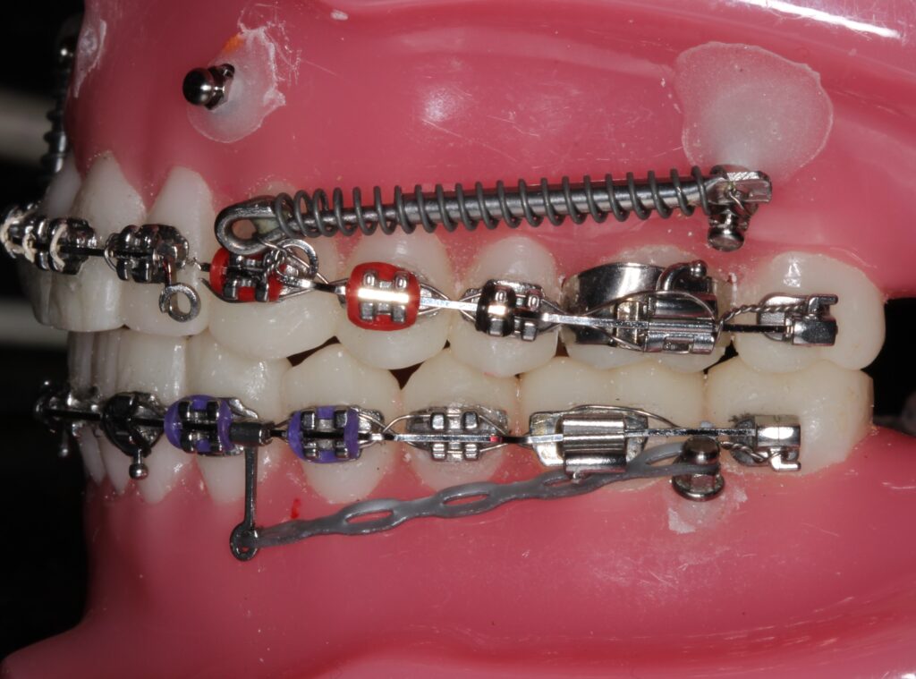 PROPULSOR INTRAMAXILAR-MAXILAR/MANDIBULAR. – Ortocompras