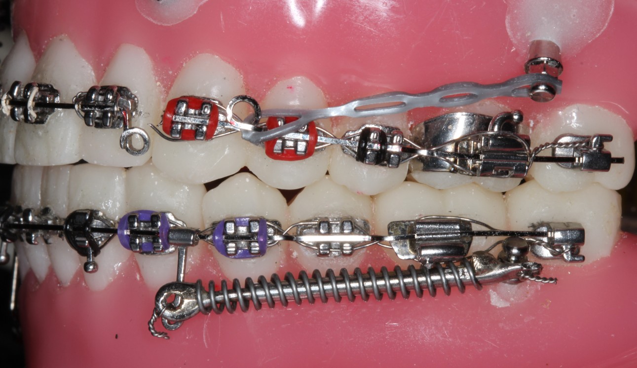 PROPULSOR INTRAMAXILAR-MAXILAR/MANDIBULAR. – Ortocompras